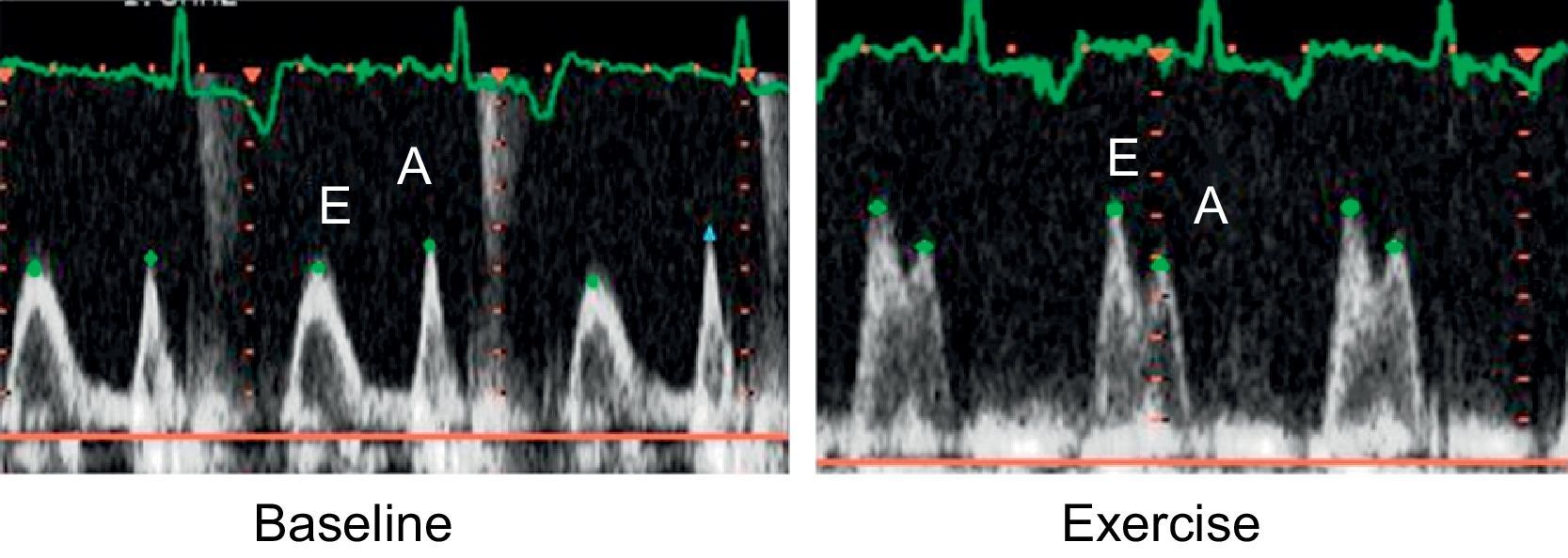 Exercise Eco-Doppler in Hypertrophic Cardiomyopathy Patients. Determinant Factors of Exercise ...