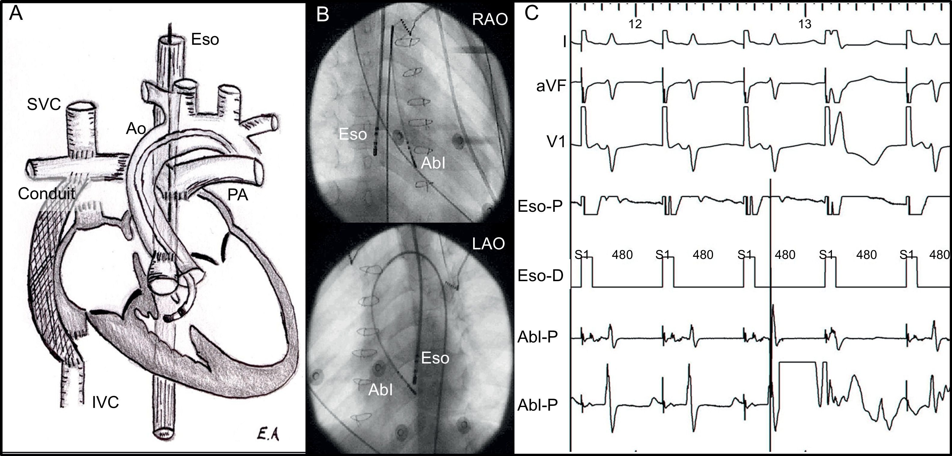 Simplified Approach for Ablation of Nodal Reentrant Tachycardia in a ...