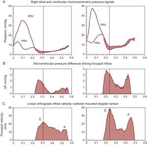 Right and Left Ventricular Diastolic Flow Field: Why Are Measured ...