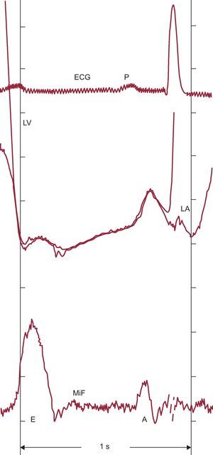 Right and Left Ventricular Diastolic Flow Field: Why Are Measured ...