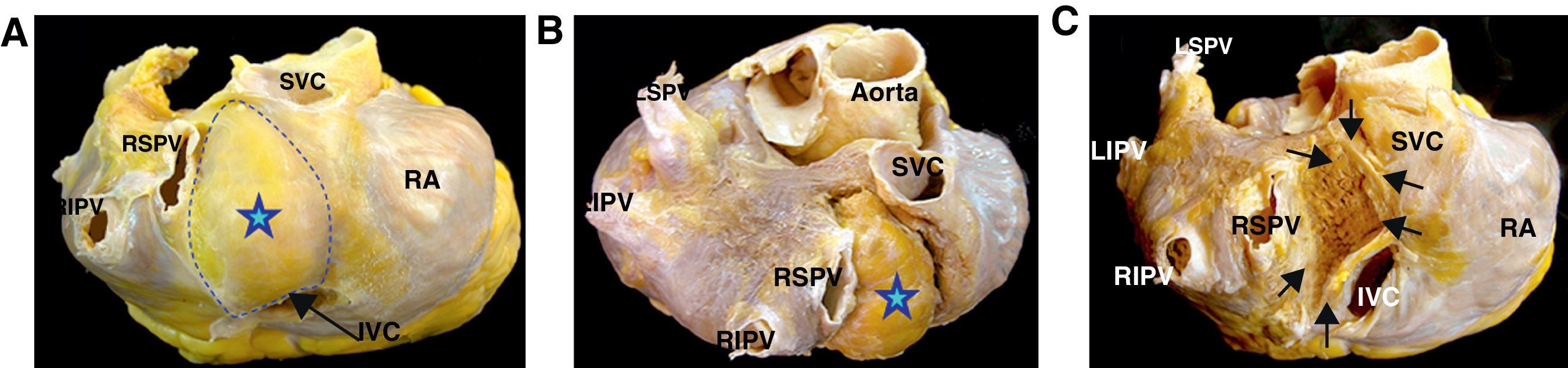 Fatty Infiltration Around the Cardiac Nodes | Revista Española de ...