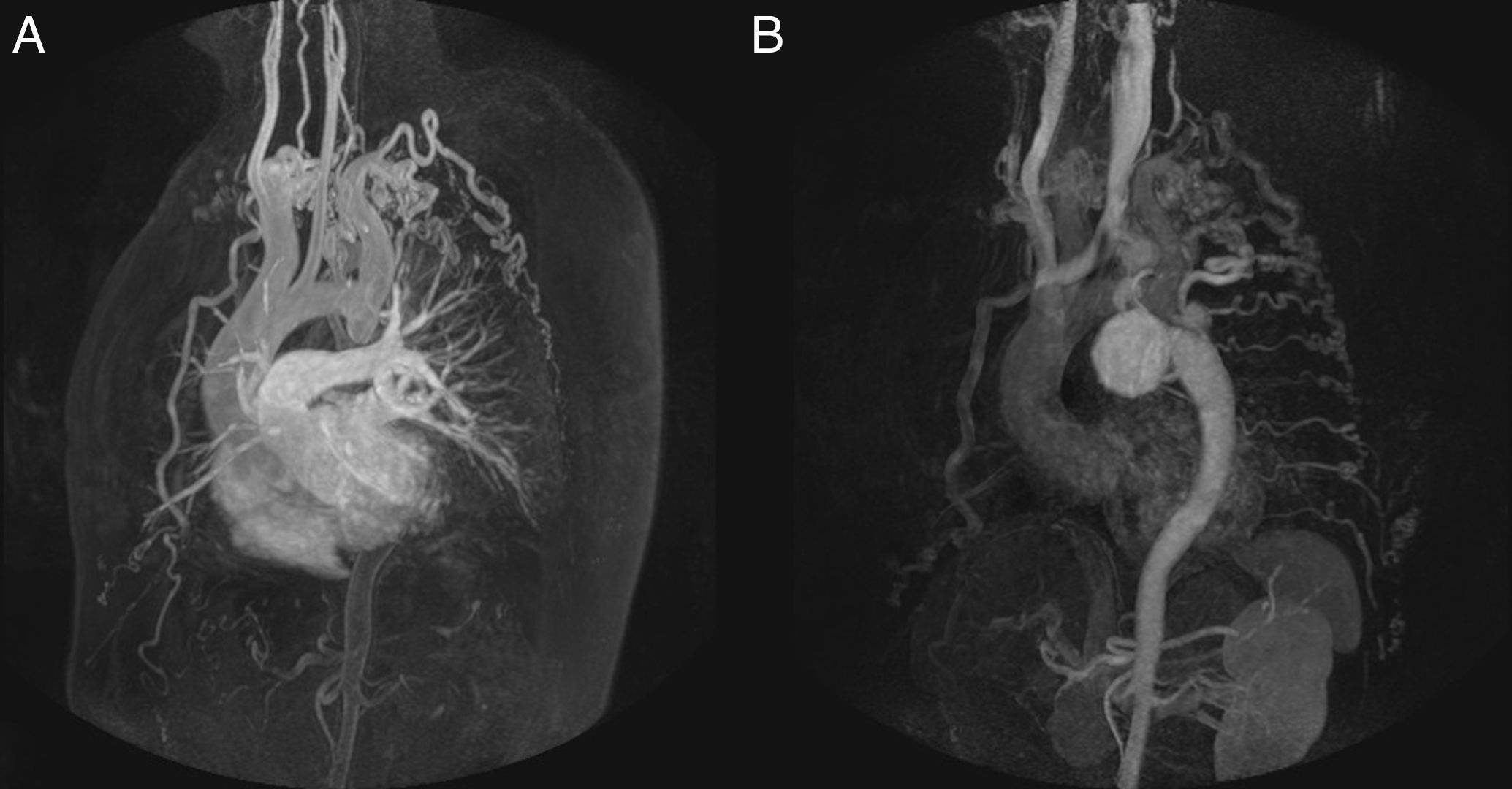 Elective Implantation of Covered Stents for Coarctation and ...