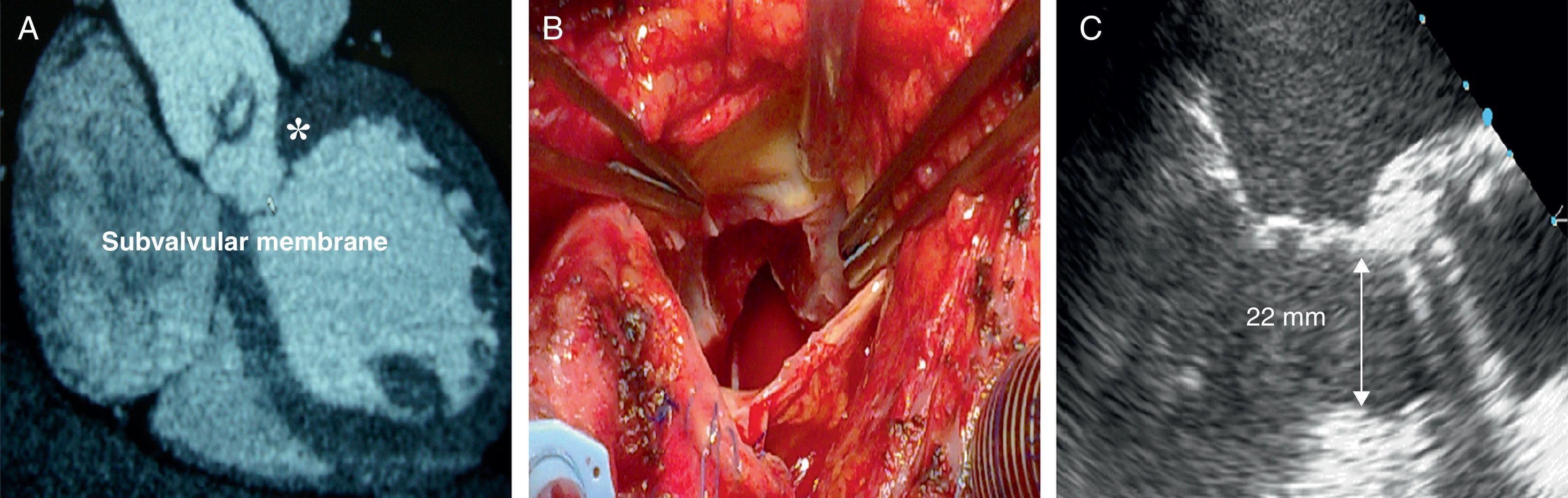 Septal Myectomy in Recurrent Subaortic Membrane | Revista Española de ...