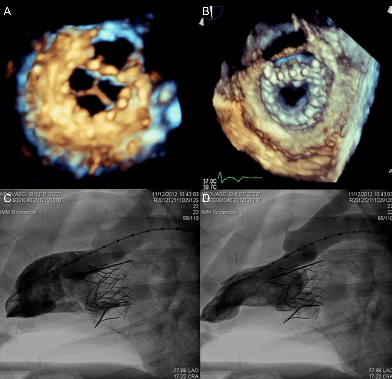 Advances in Percutaneous Treatment of Mitral Regurgitation | Revista ...