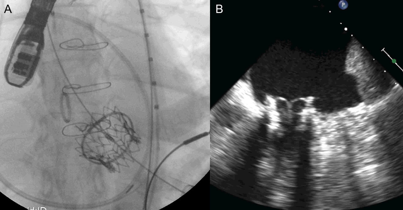 Advances in Percutaneous Treatment of Mitral Regurgitation | Revista ...