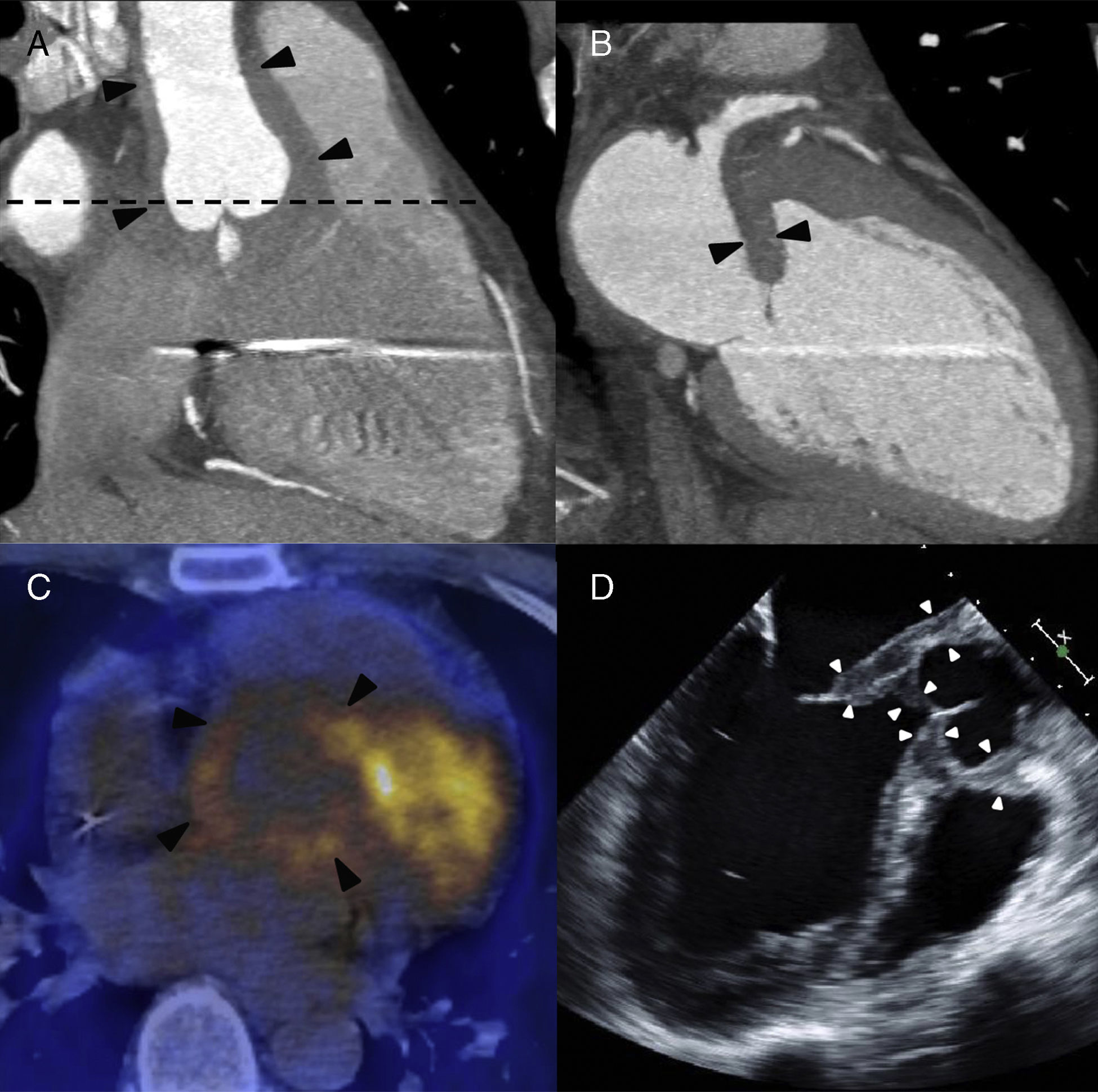 Fibrotic Periaortitis Infiltrating Into the Aortic and Mitral Valves ...