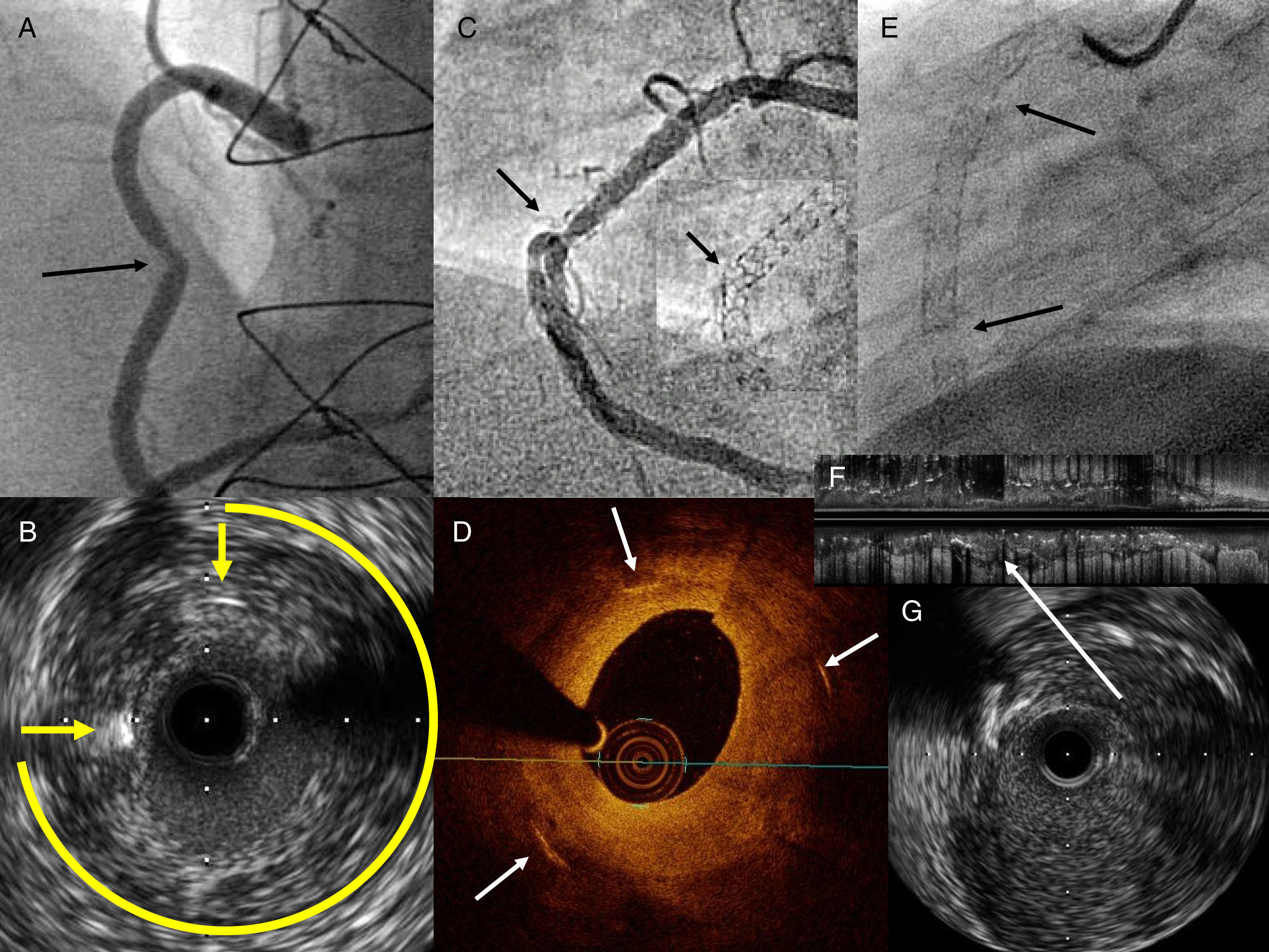 Intravascular Diagnosis of Stent Fractures: Beyond X-ray Imaging ...