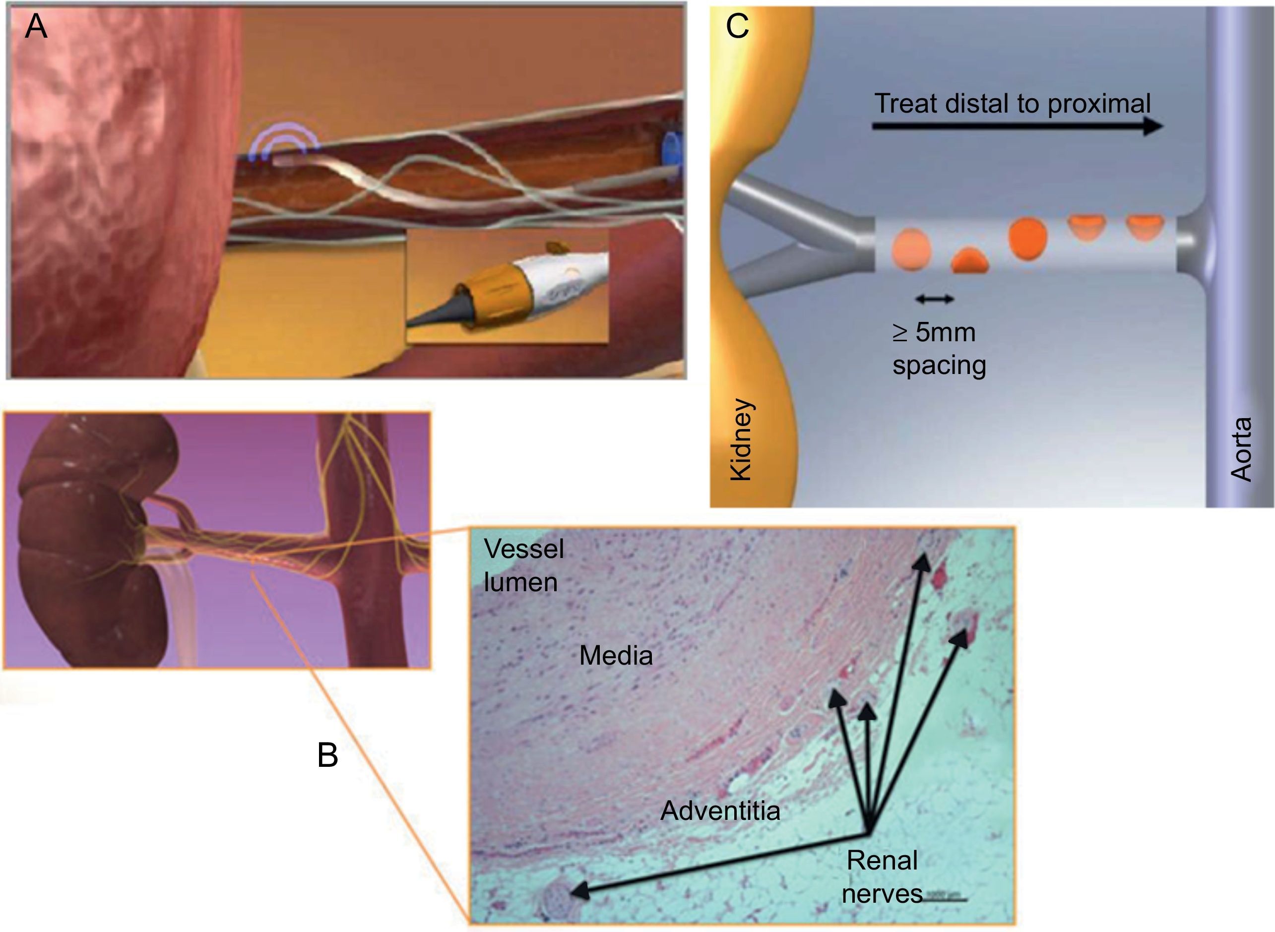 New Treatment for Old Disease: Management of Resistant Hypertension by ...