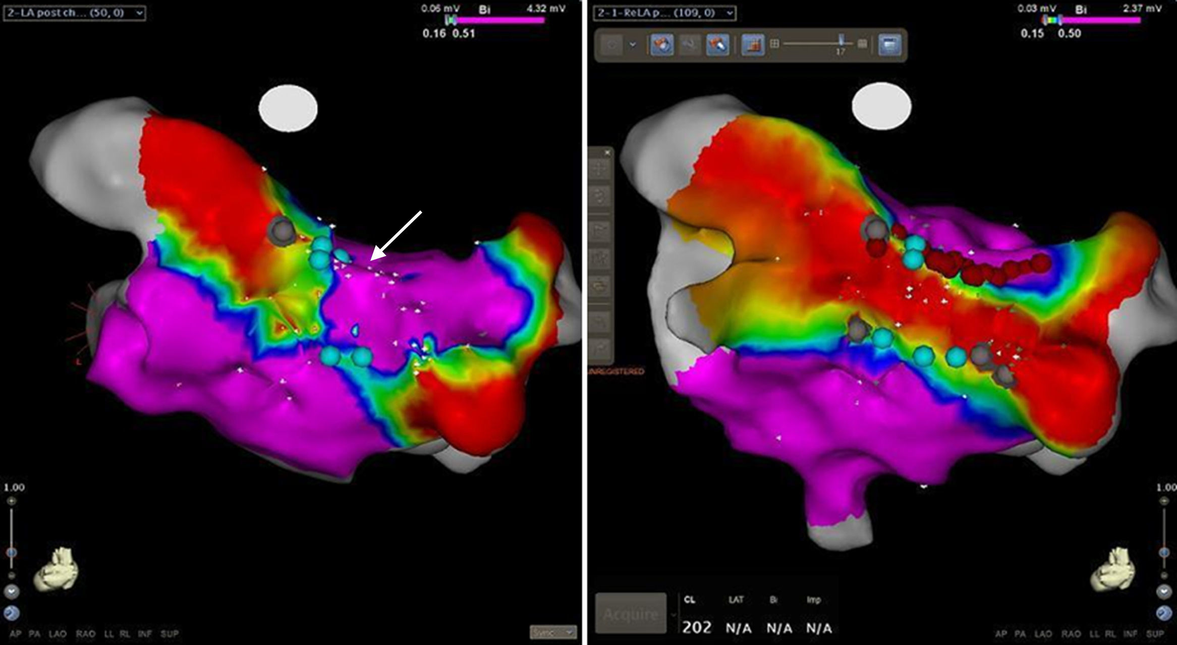 Endocardial Completion of Epicardial Linear Ablation During Hybrid ...