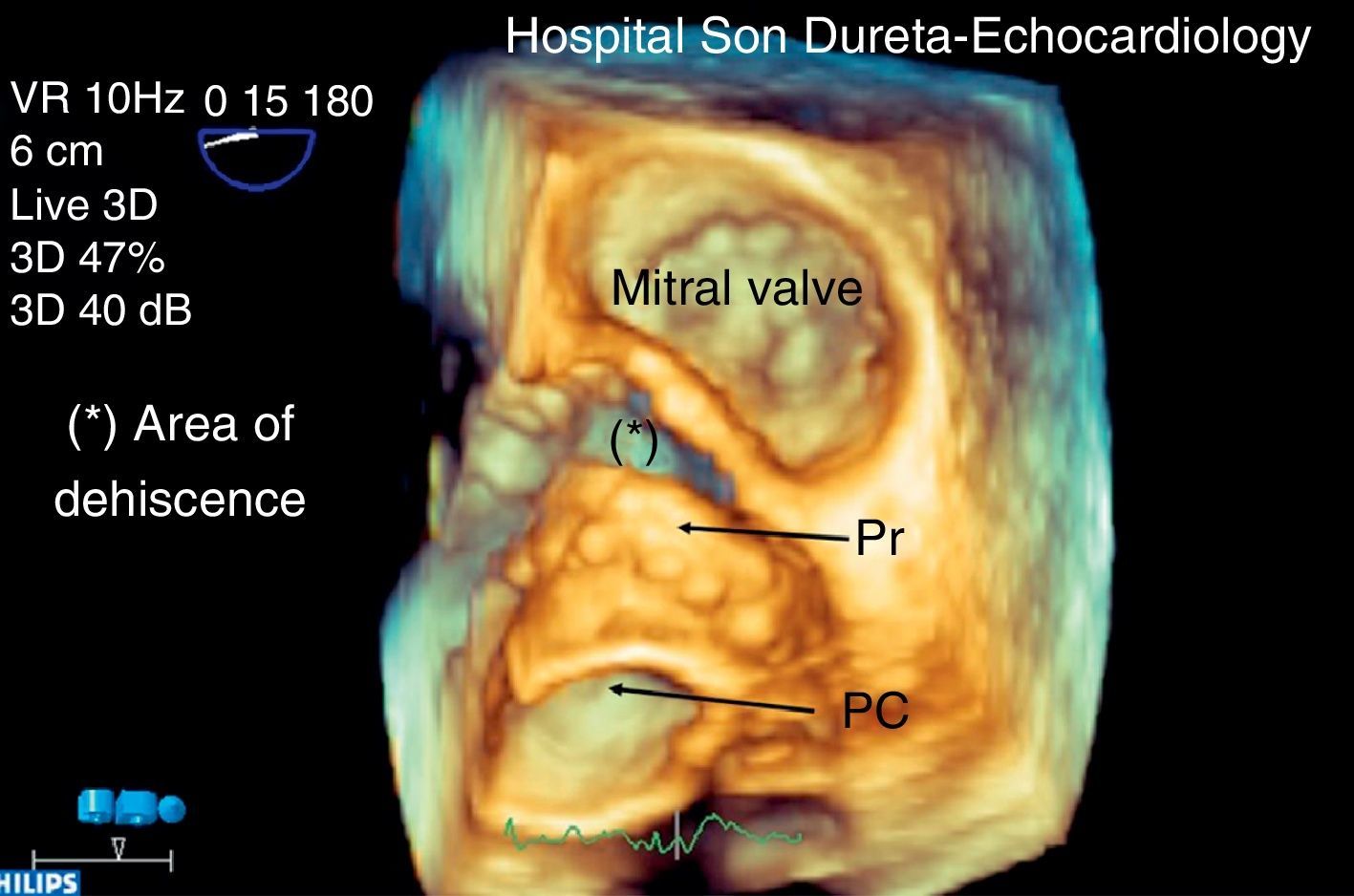 Dehiscence of an Aortic Valved Conduit: A Three-dimensional ...