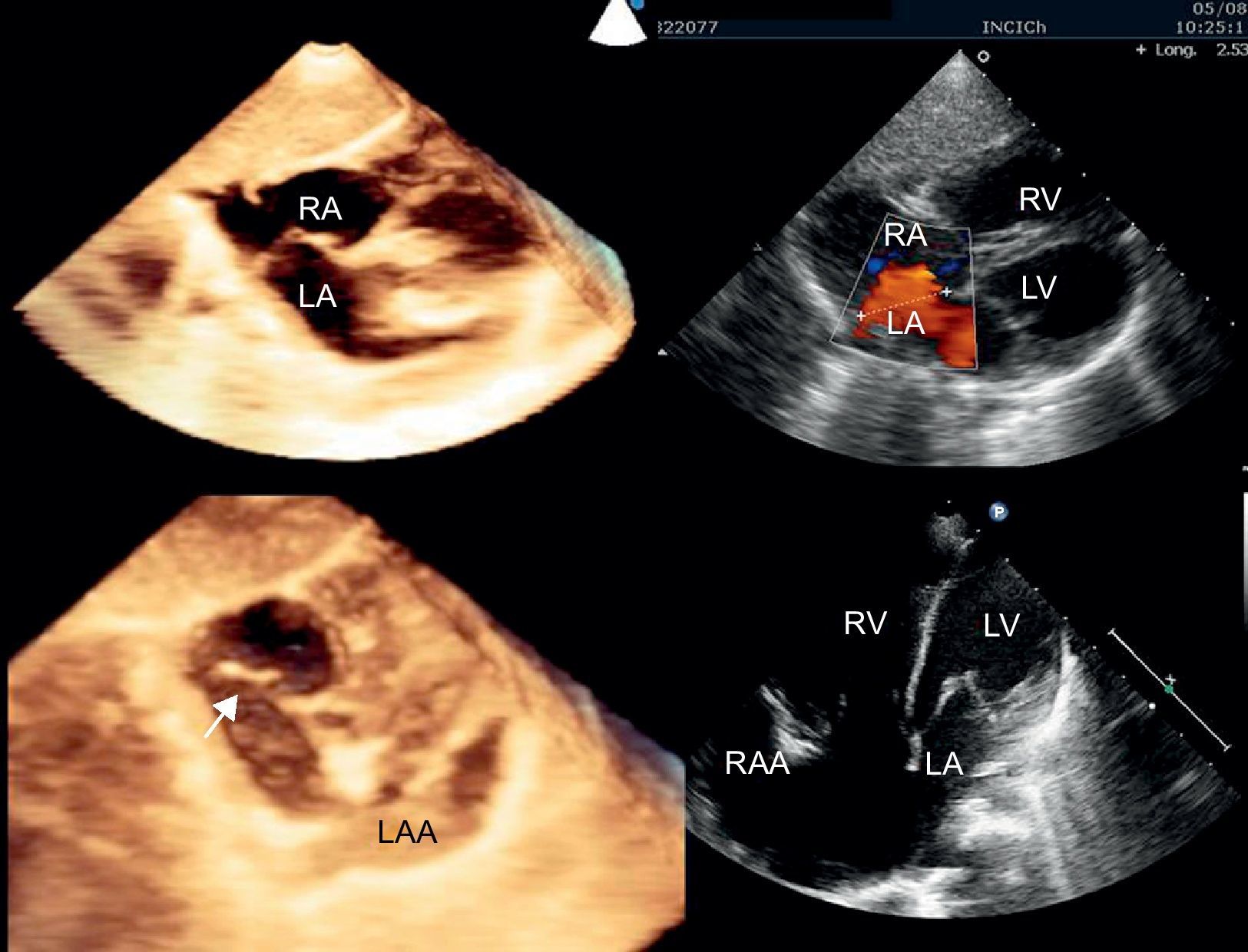 Left Atrial Appendage Aneurysm and Atrial Septal Defect | Revista ...