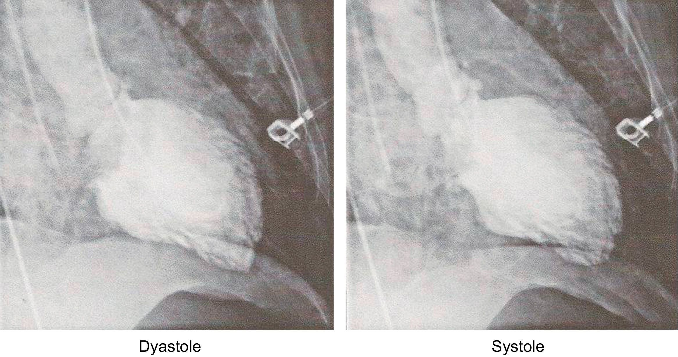 Histologic and Angiographic Imaging of Acute Shock Dengue Myocarditis