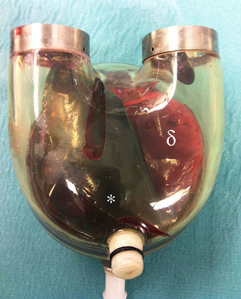 A Serious Complication in a Patient With a Ventricular Assist Device ...