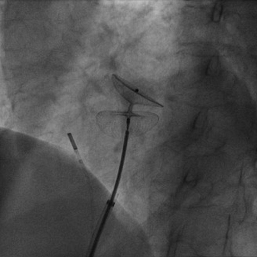 Patent Foramen Ovale Causing Severe Hypoxemia Due to Right-to-left ...