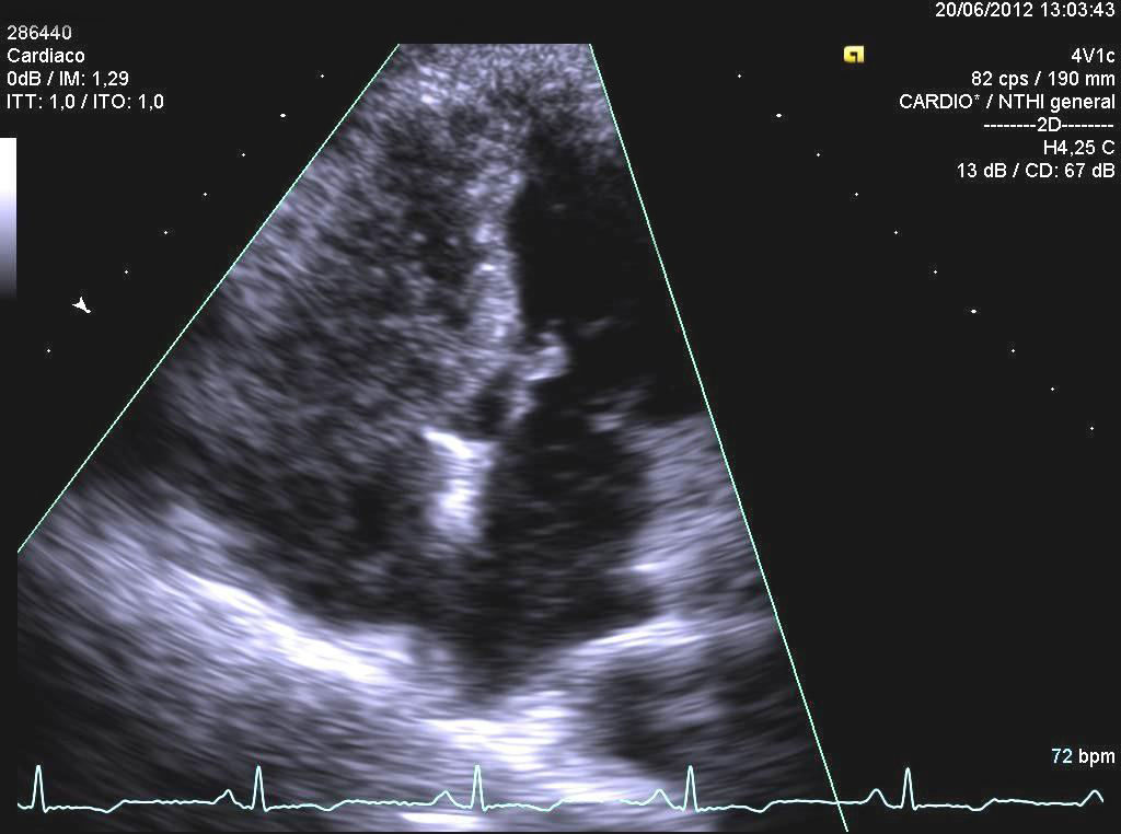 Patent Foramen Ovale Causing Severe Hypoxemia Due to Right-to-left ...