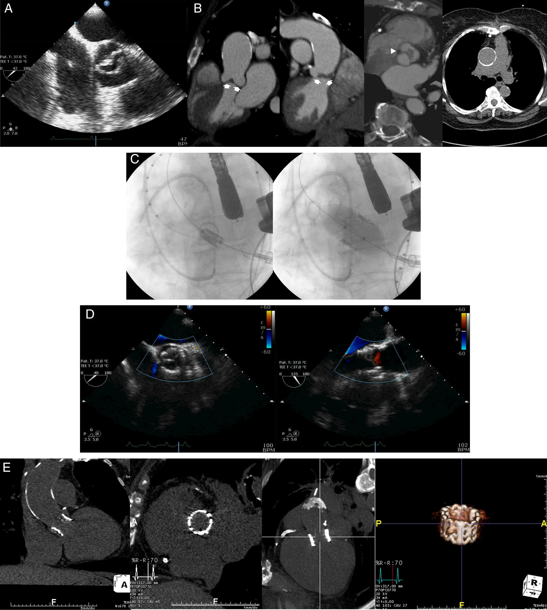 Transcatheter Aortic Valve Replacement With a Balloon-expandable Valve ...