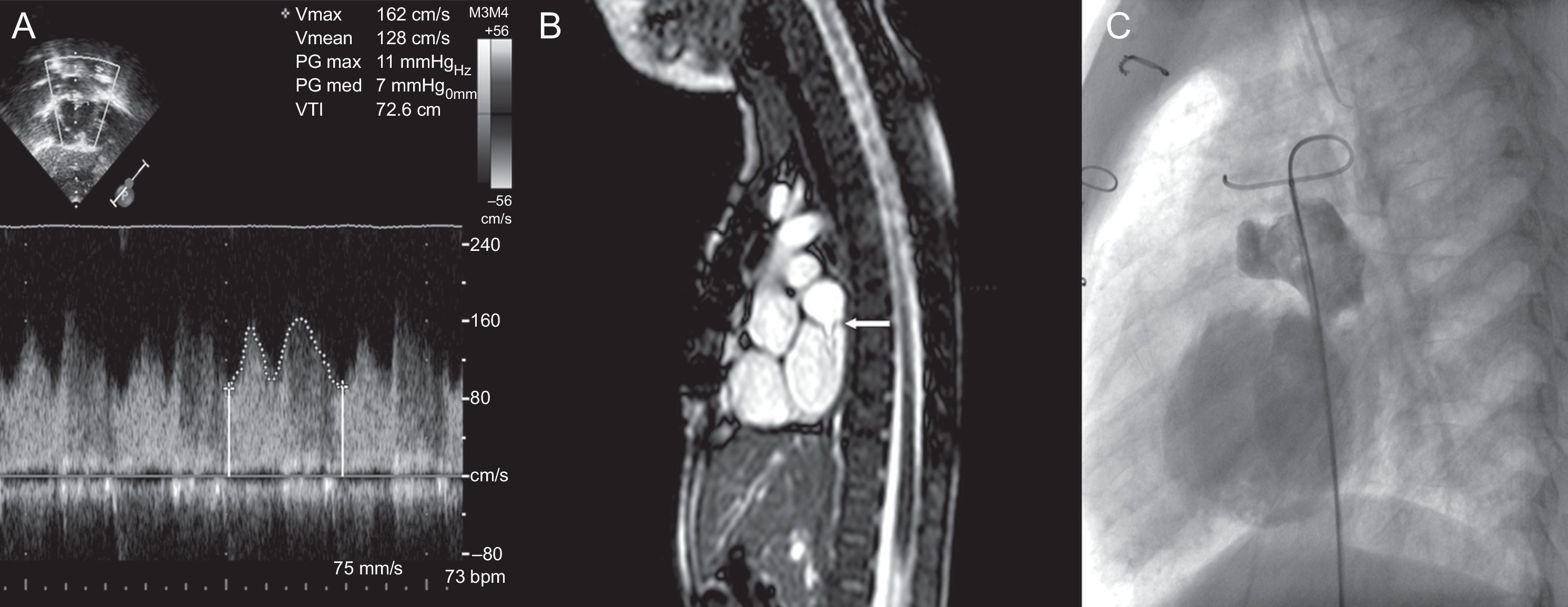Stent Implantation in the Anastomosis After Correction of a Total ...