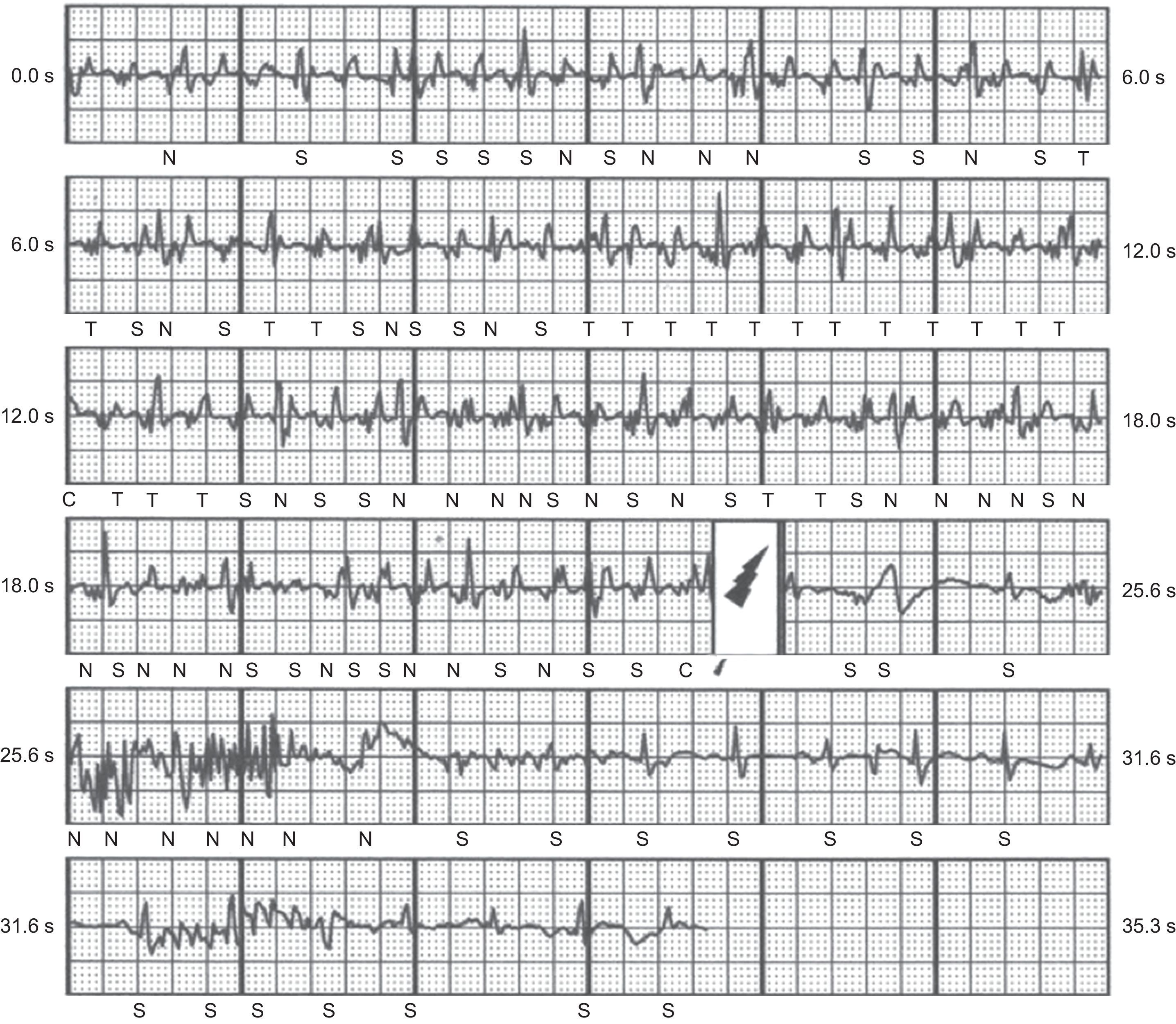 Inappropriate Defibrillator Shock in a Subcutaneous Device Secondary to ...