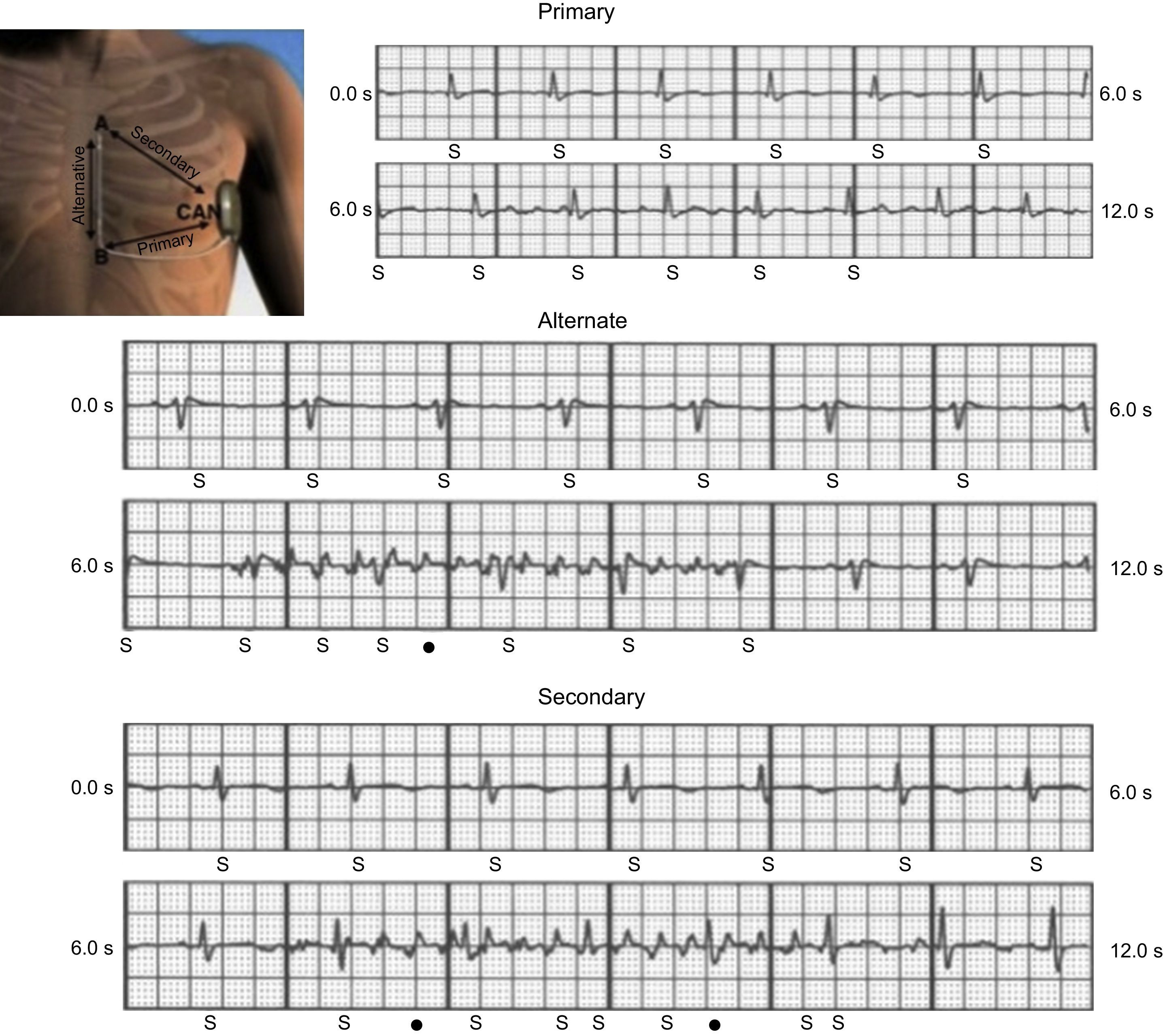 Inappropriate Defibrillator Shock in a Subcutaneous Device Secondary to ...