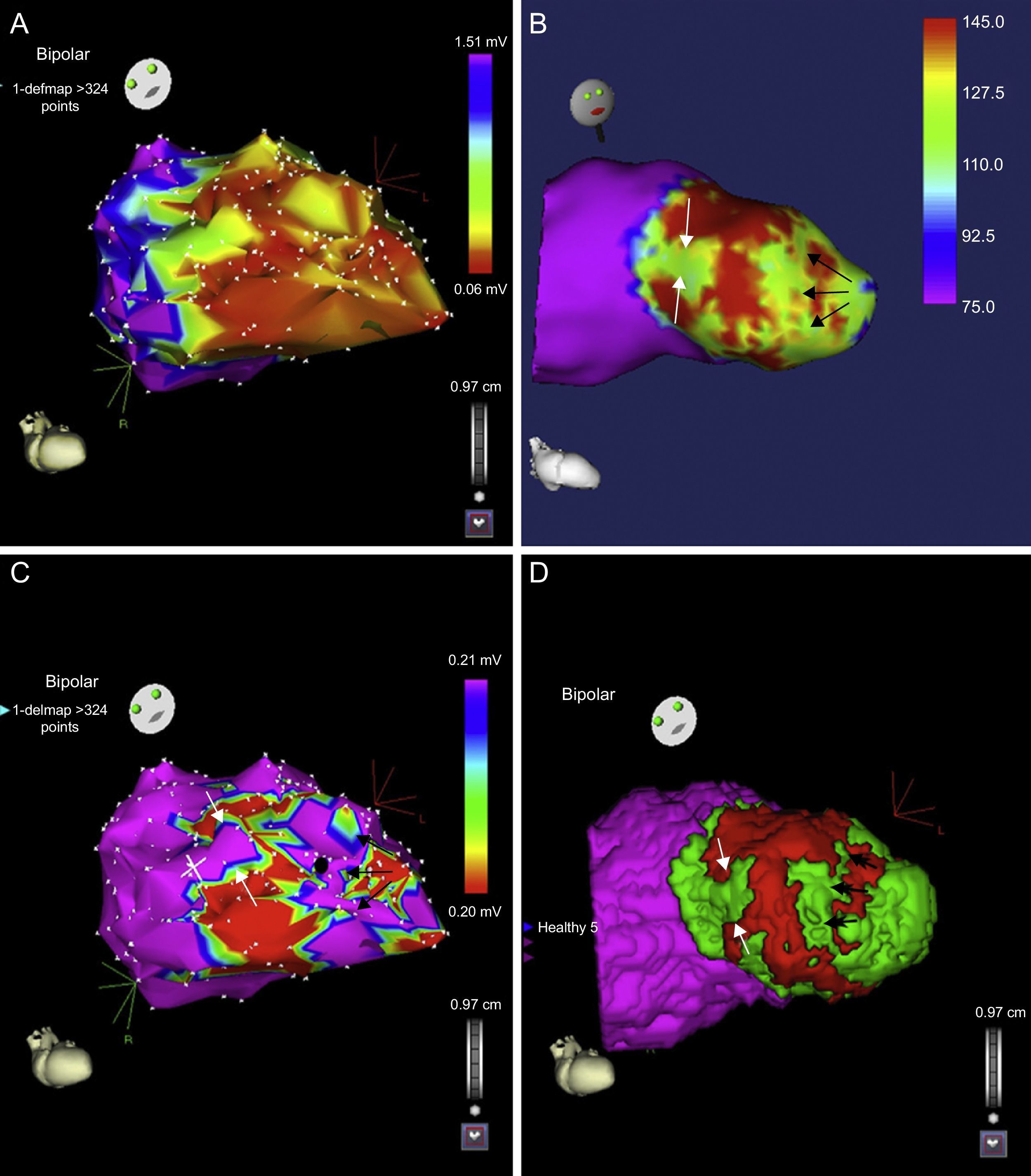Substrate Ablation of Post-infarction Ventricular Tachycardias ...
