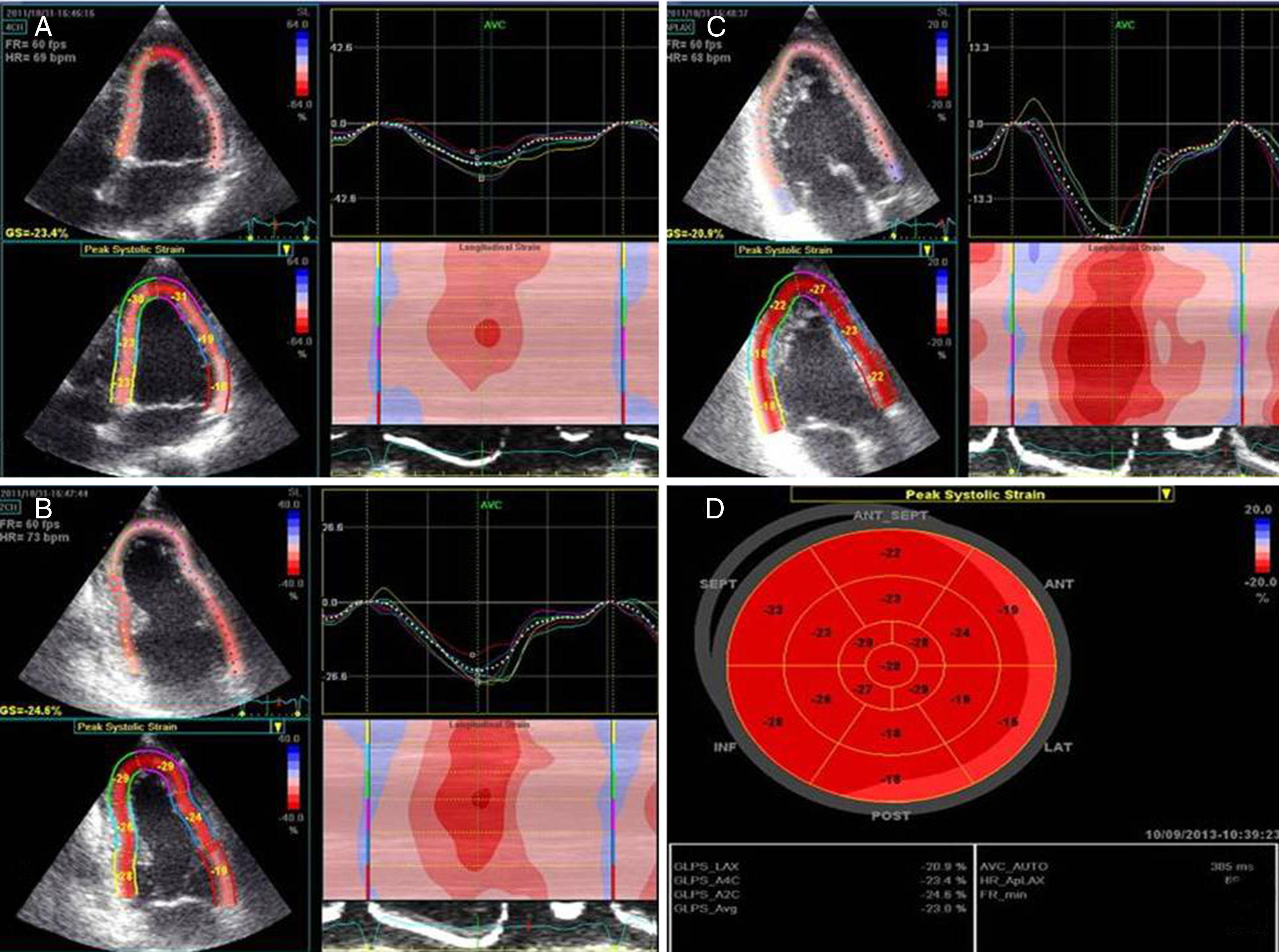 Normal Left Ventricular Mechanics by Two-dimensional Speckle-tracking ...