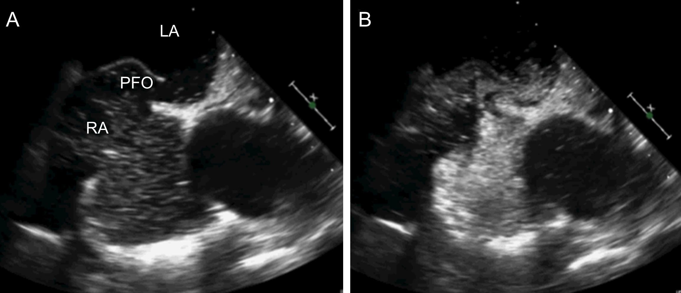 Current Indications for Percutaneous Closure of Patent Foramen Ovale ...