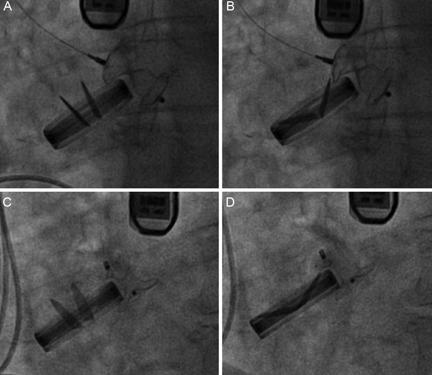 Immediate and Mid-term Clinical Course After Percutaneous Closure of ...