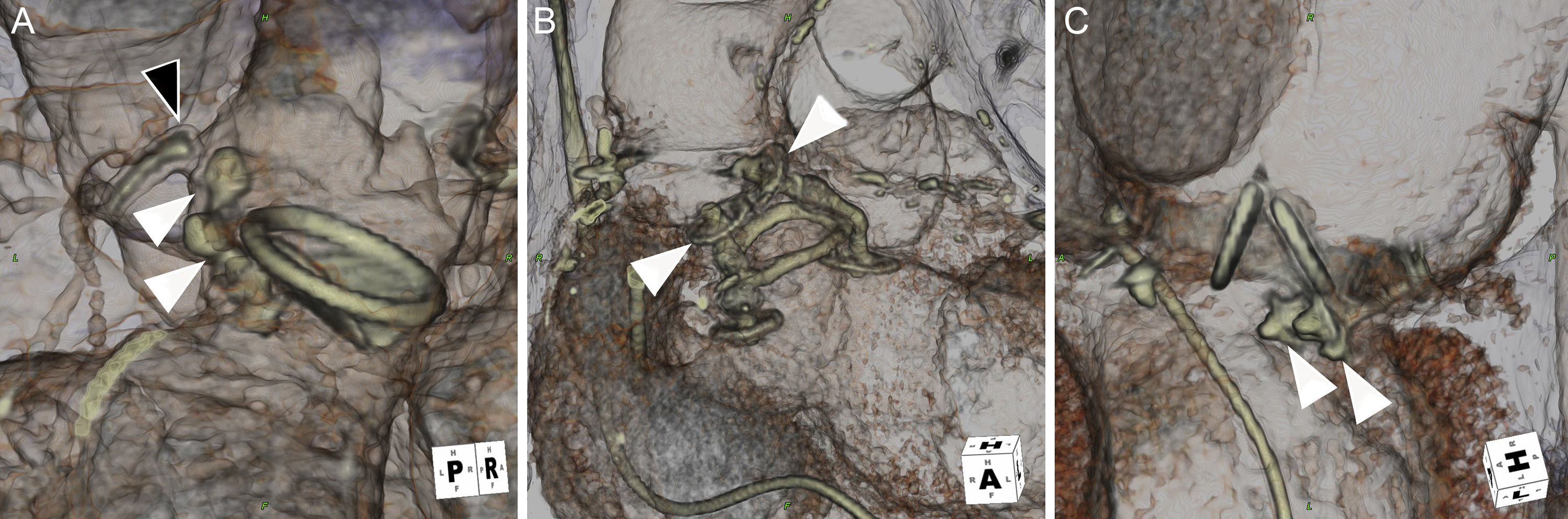 Rethinking Percutaneous Paravalvular Leak Closure: Where Do We Go From ...