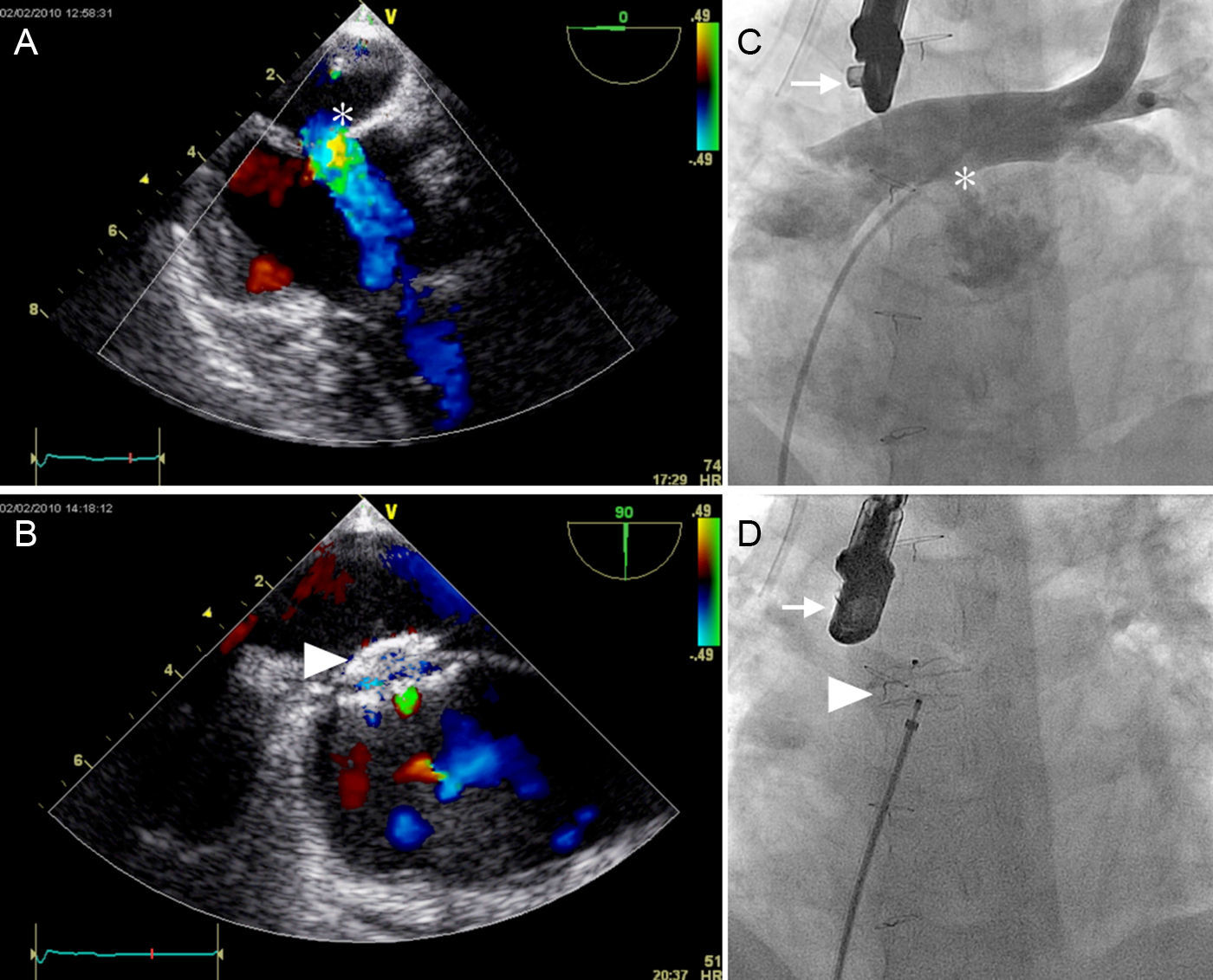 Percutaneous Closure of Baffle Leaks in Patients With Atrial Switch ...