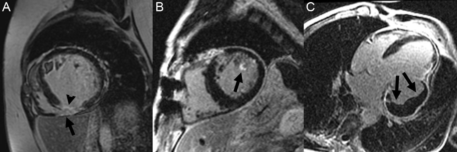 Imaging Techniques in the Evaluation of Post-infarction Function and ...
