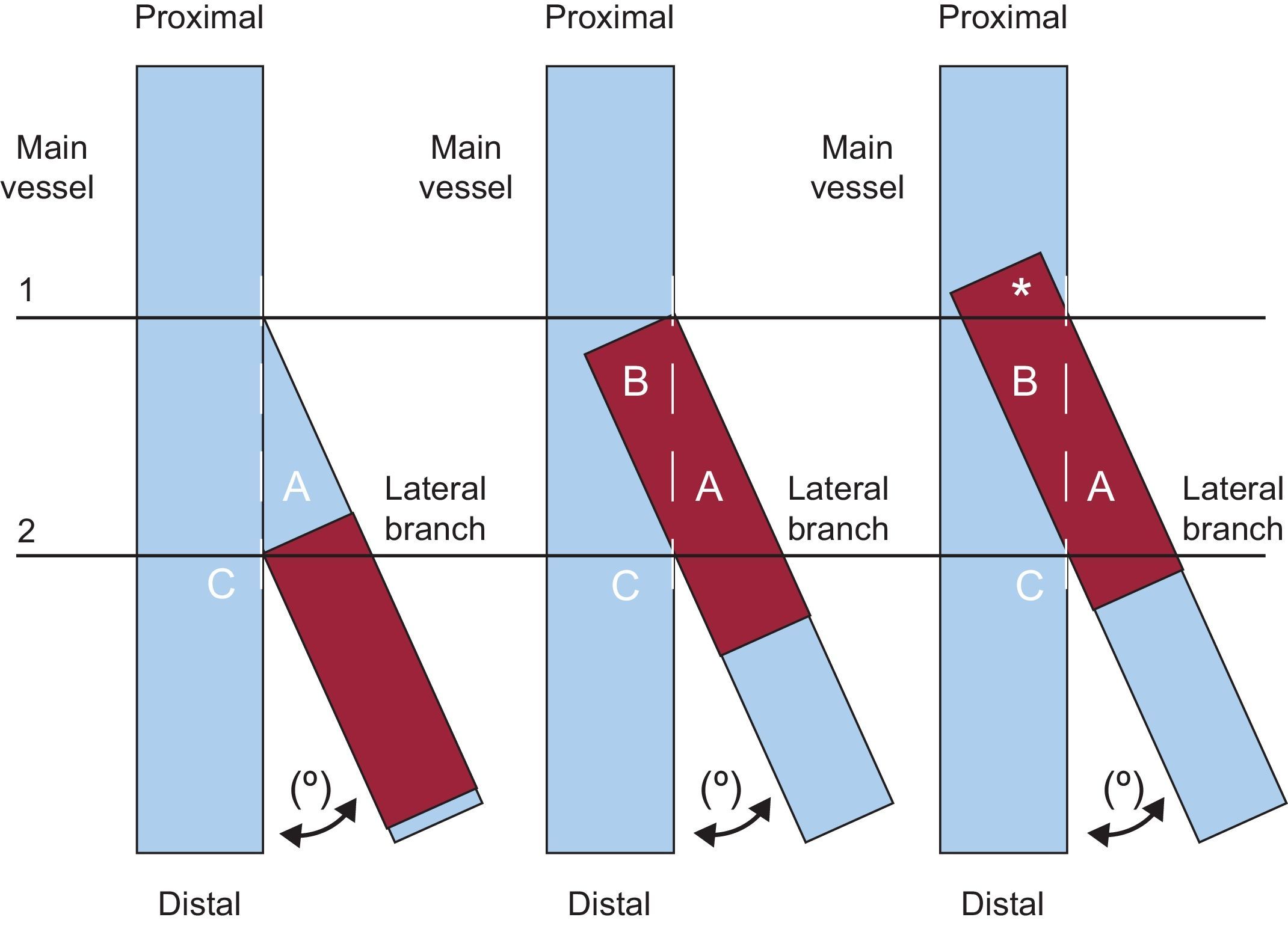 Do We Know How to Treat Bifurcation Coronary Lesions? | Revista ...