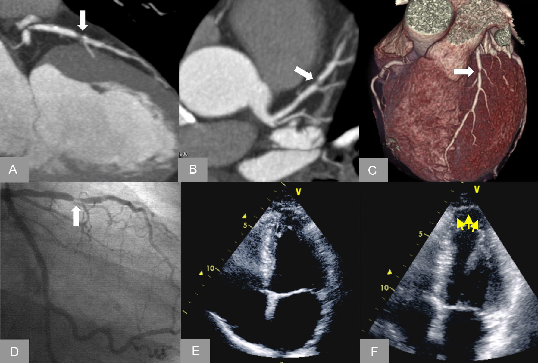Exercise Echocardiography and Multidetector Computed Tomography for the ...