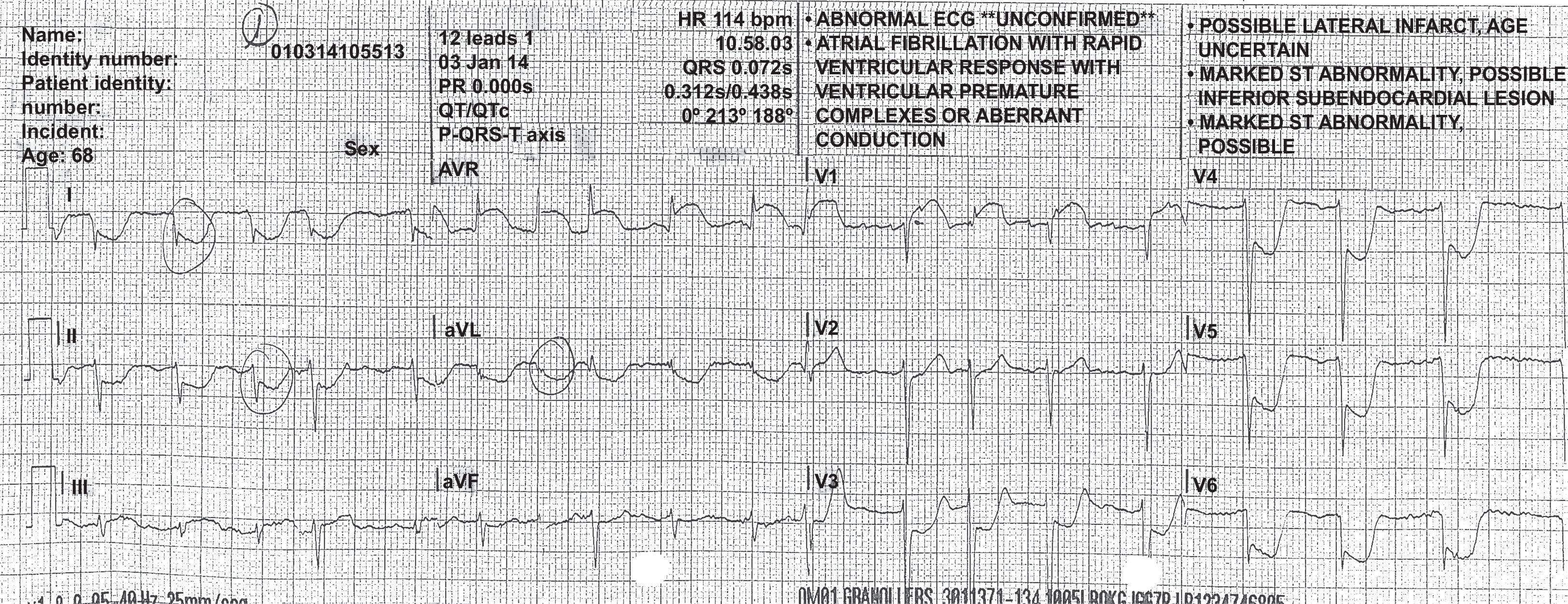 ECG, March 2015 | Revista Española de Cardiología
