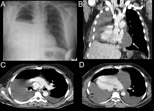 Cardiac Herniation With Torsion: Complication After Pleuropneumonectomy ...