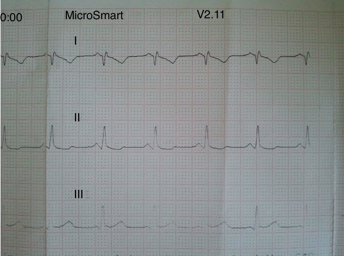 Cardiac Herniation With Torsion: Complication After Pleuropneumonectomy ...