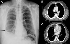 Cardiac Herniation With Torsion: Complication After Pleuropneumonectomy ...