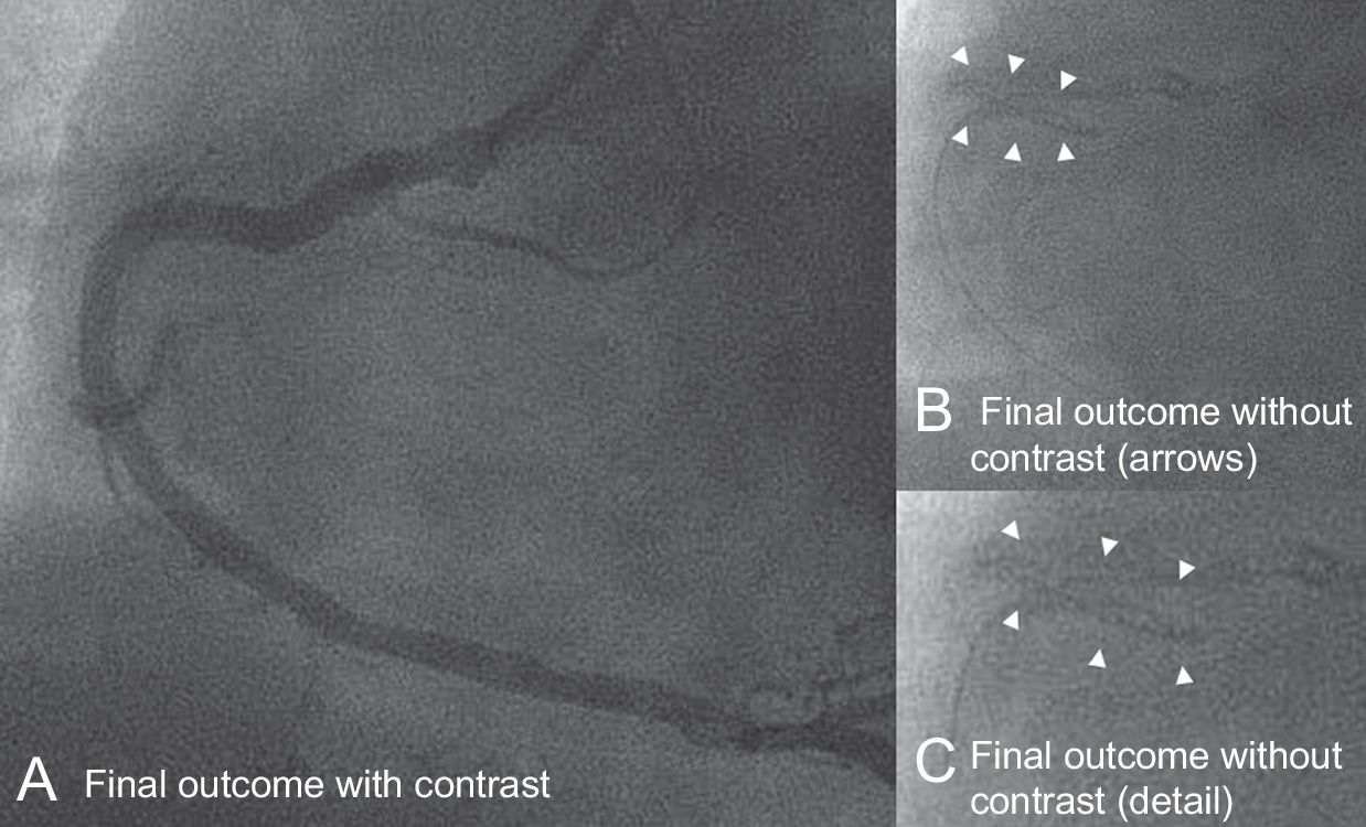 Optical Coherence Tomography in Complicated Coronary Angioplasty ...