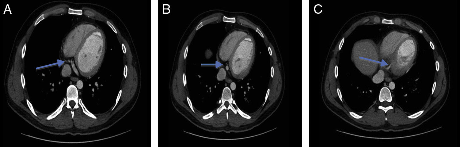 Atretic Coronary Sinus Orifice With a Persistent Left Superior Vena Cava