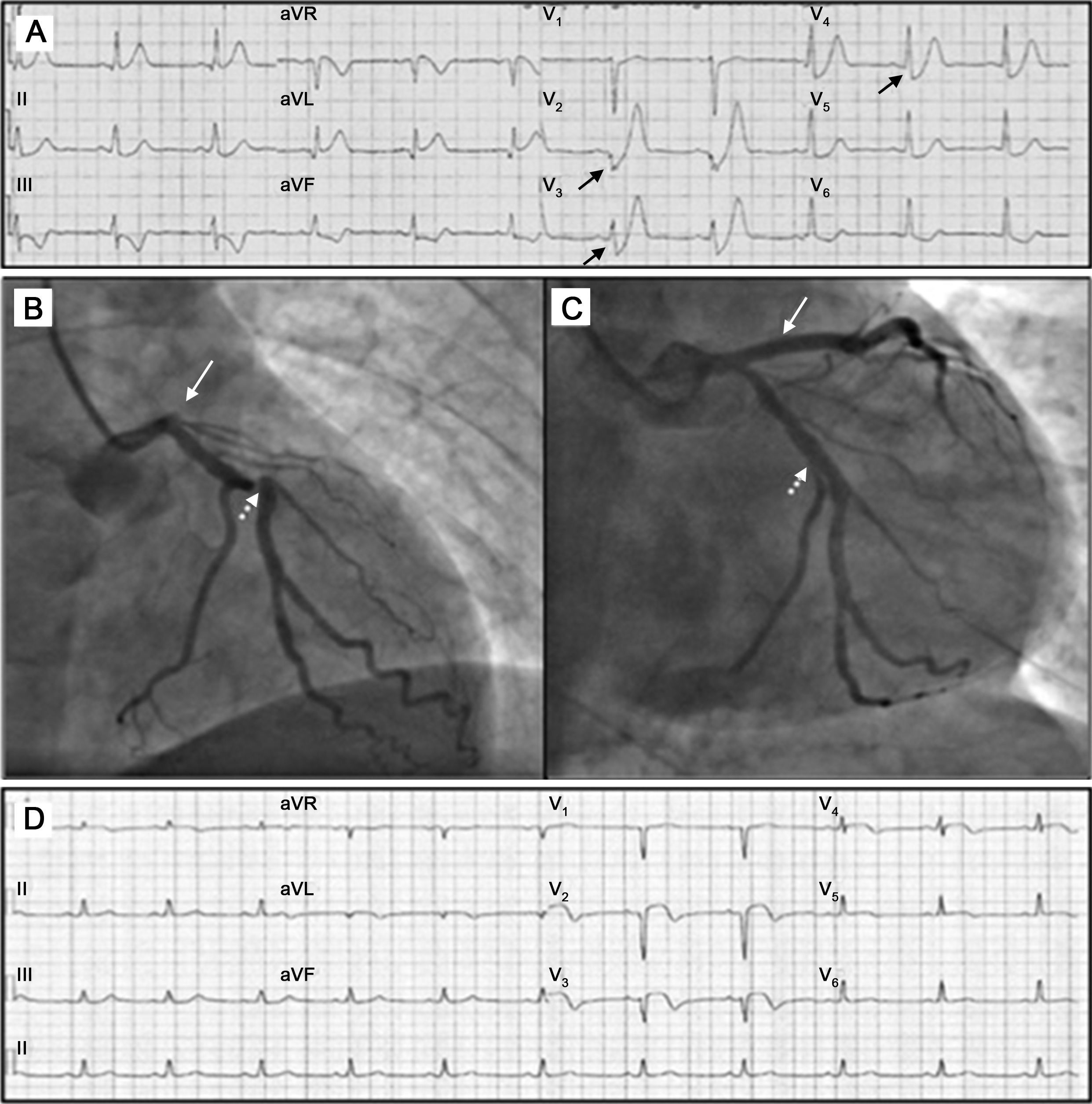 Proximal Left Anterior Descending Artery Acute Occlusion With an ...
