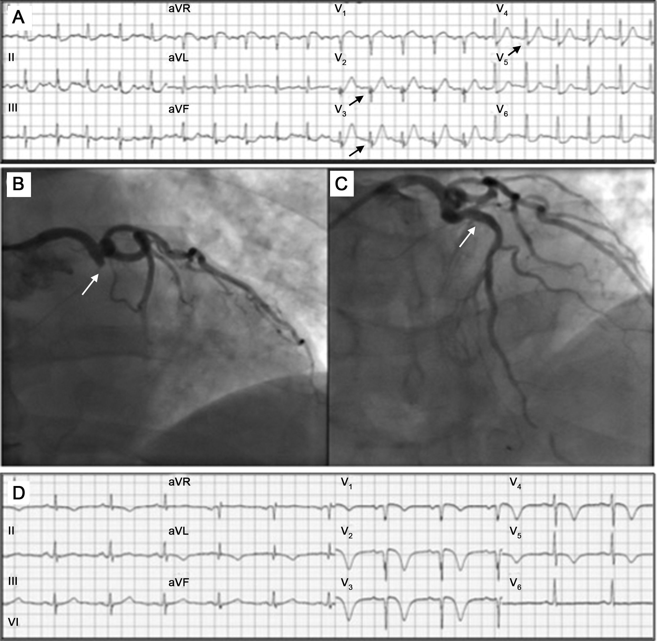 Proximal Left Anterior Descending Artery Acute Occlusion With an ...