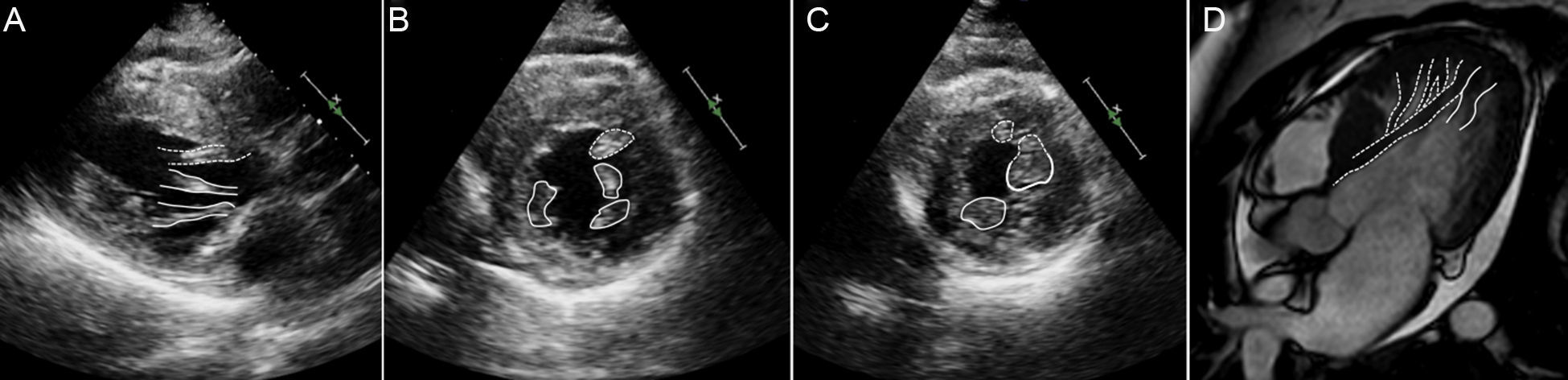 Little-known Aspects in Hypertrophic Cardiomyopathy | Revista Española ...
