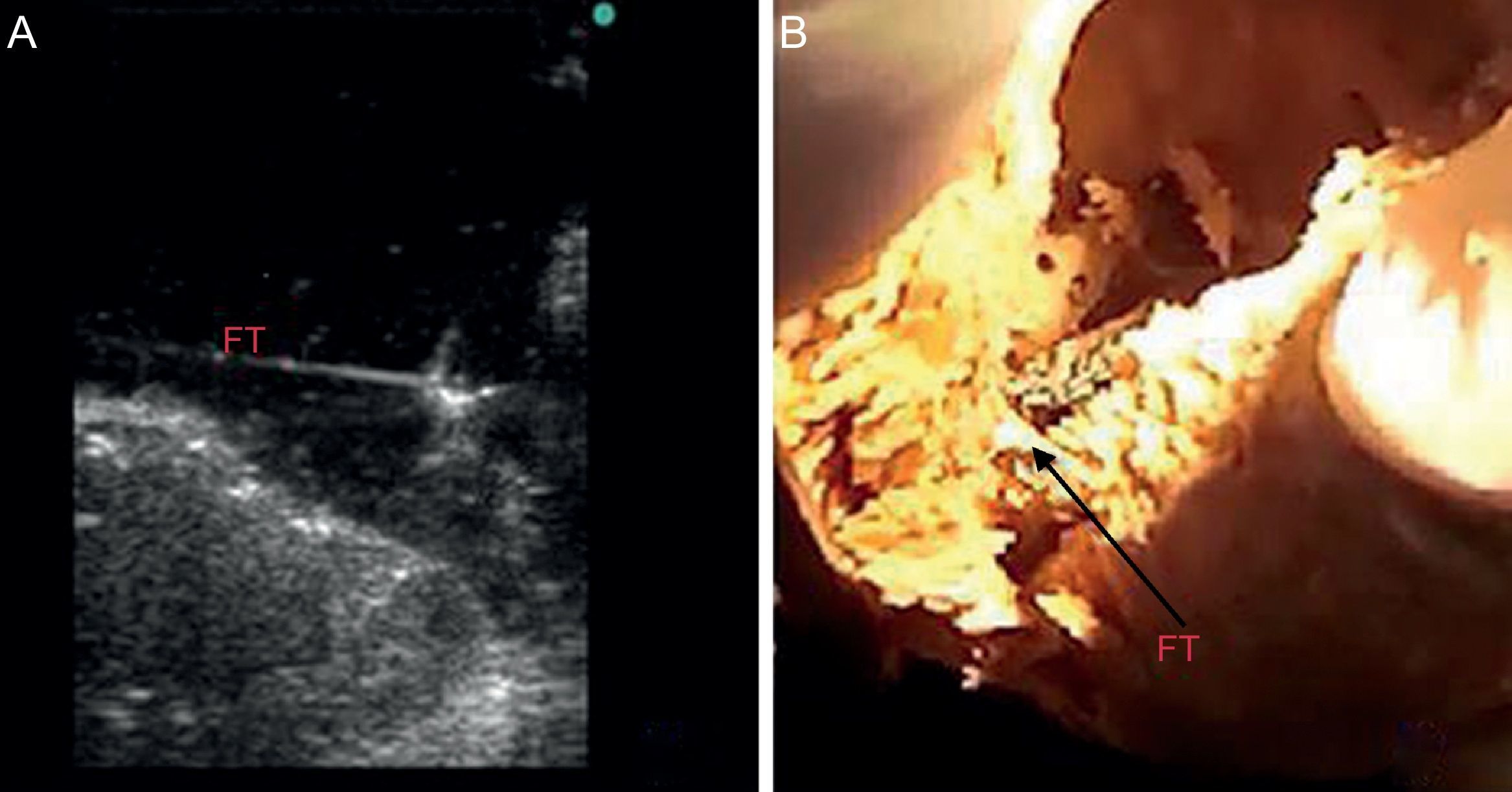 Basic Study and Clinical Implications of Left Ventricular False Tendon ...