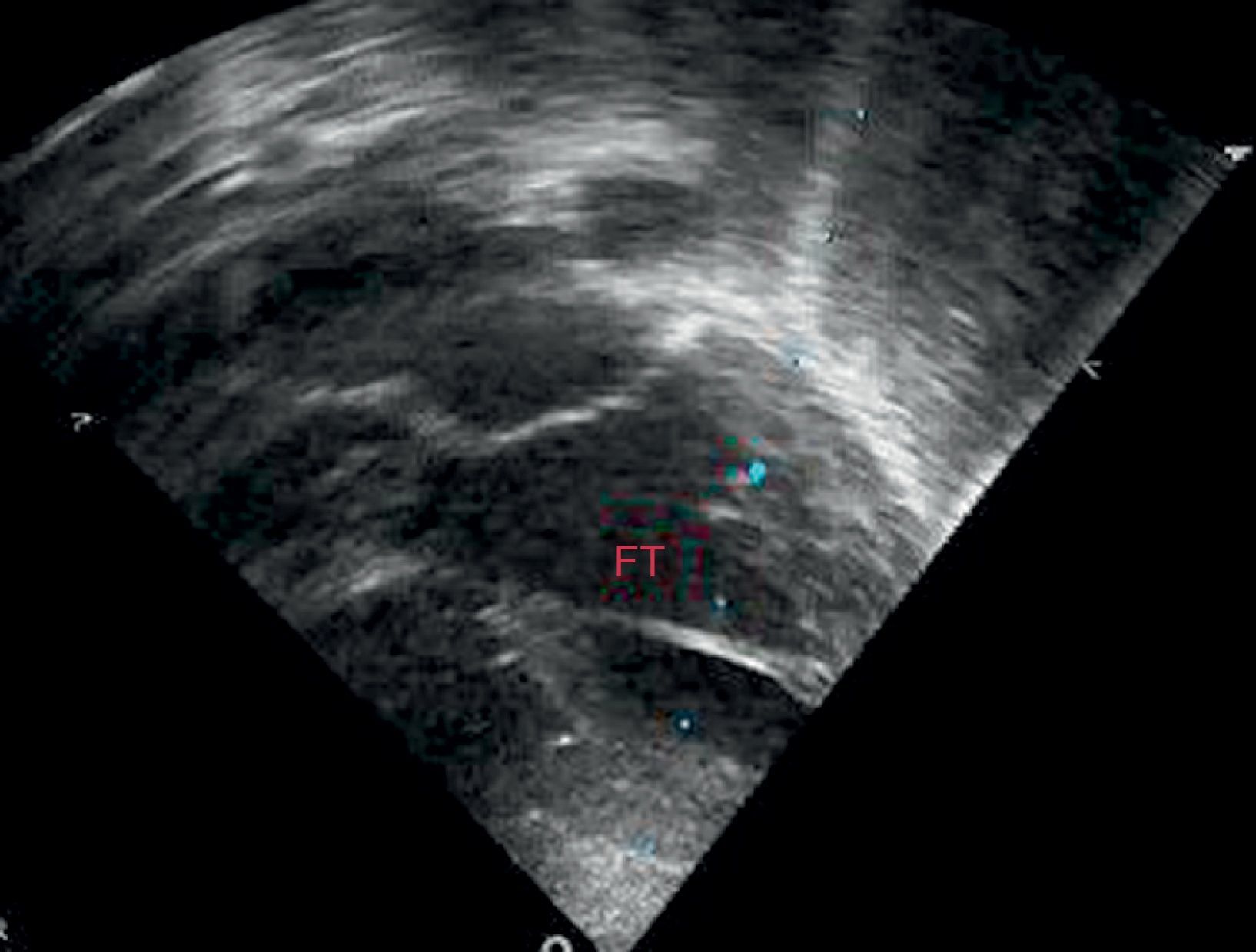 Basic Study and Clinical Implications of Left Ventricular False Tendon ...