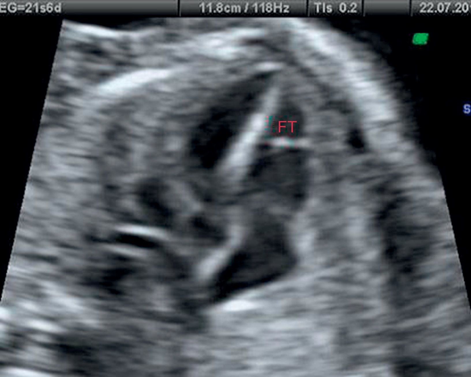 Basic Study and Clinical Implications of Left Ventricular False Tendon ...