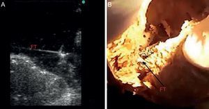 Basic Study and Clinical Implications of Left Ventricular False Tendon ...