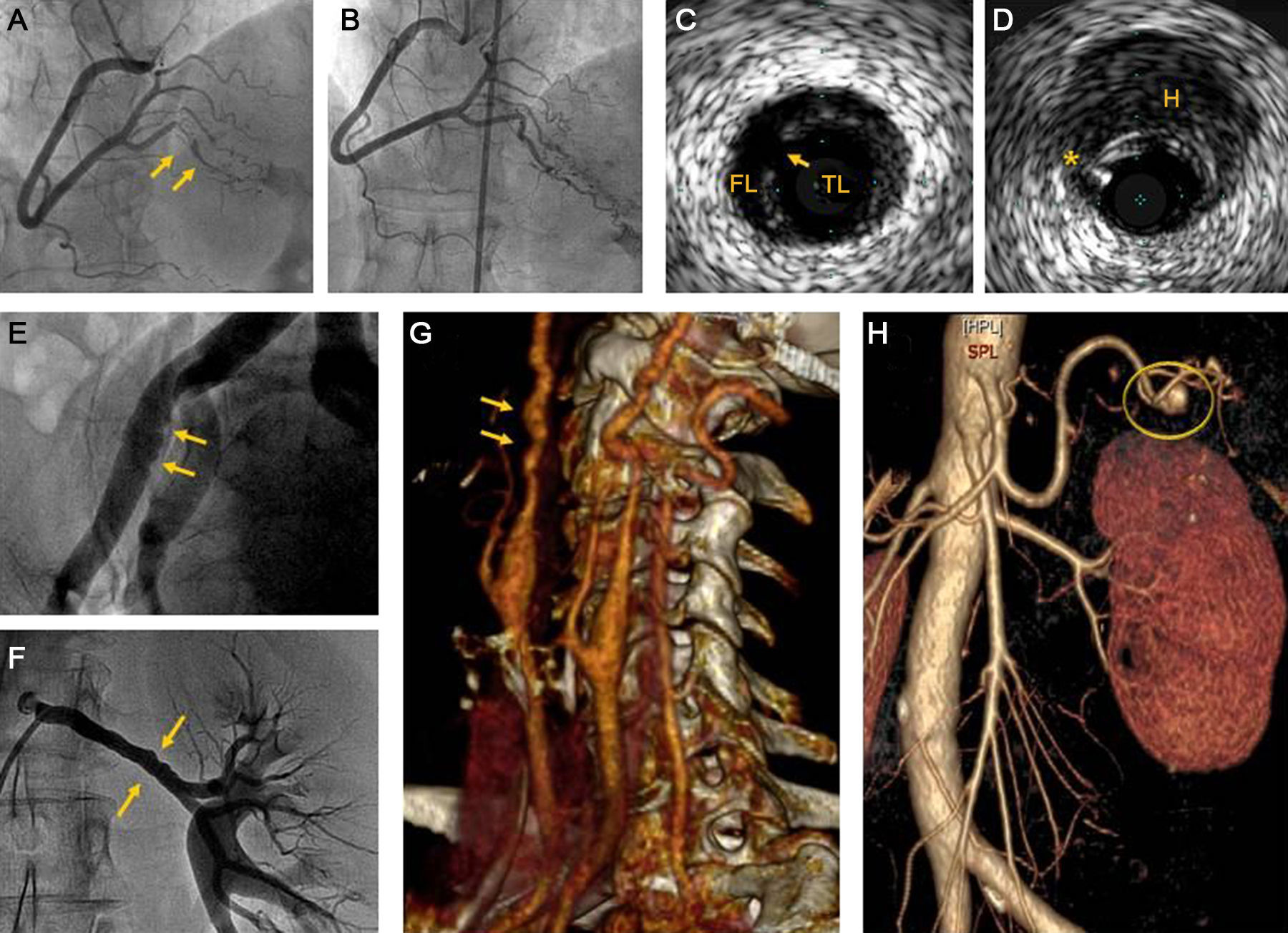 Association of Spontaneous Coronary Artery Dissection With ...