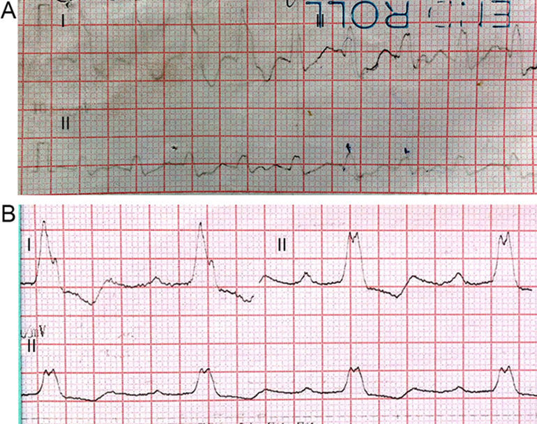 Echocardiographic Diagnosis of Ventricular Tachycardia | Revista ...