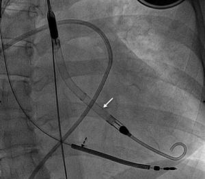 Impella CP® Circulatory Support Device as a Bridge to Heart ...