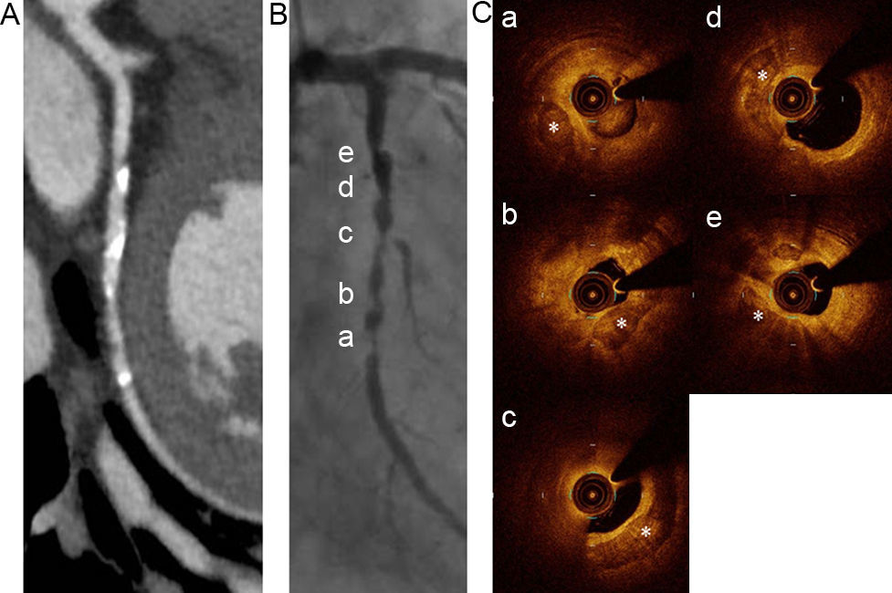 Optical Coherence Tomography Findings After Scoring Balloon Dilatation