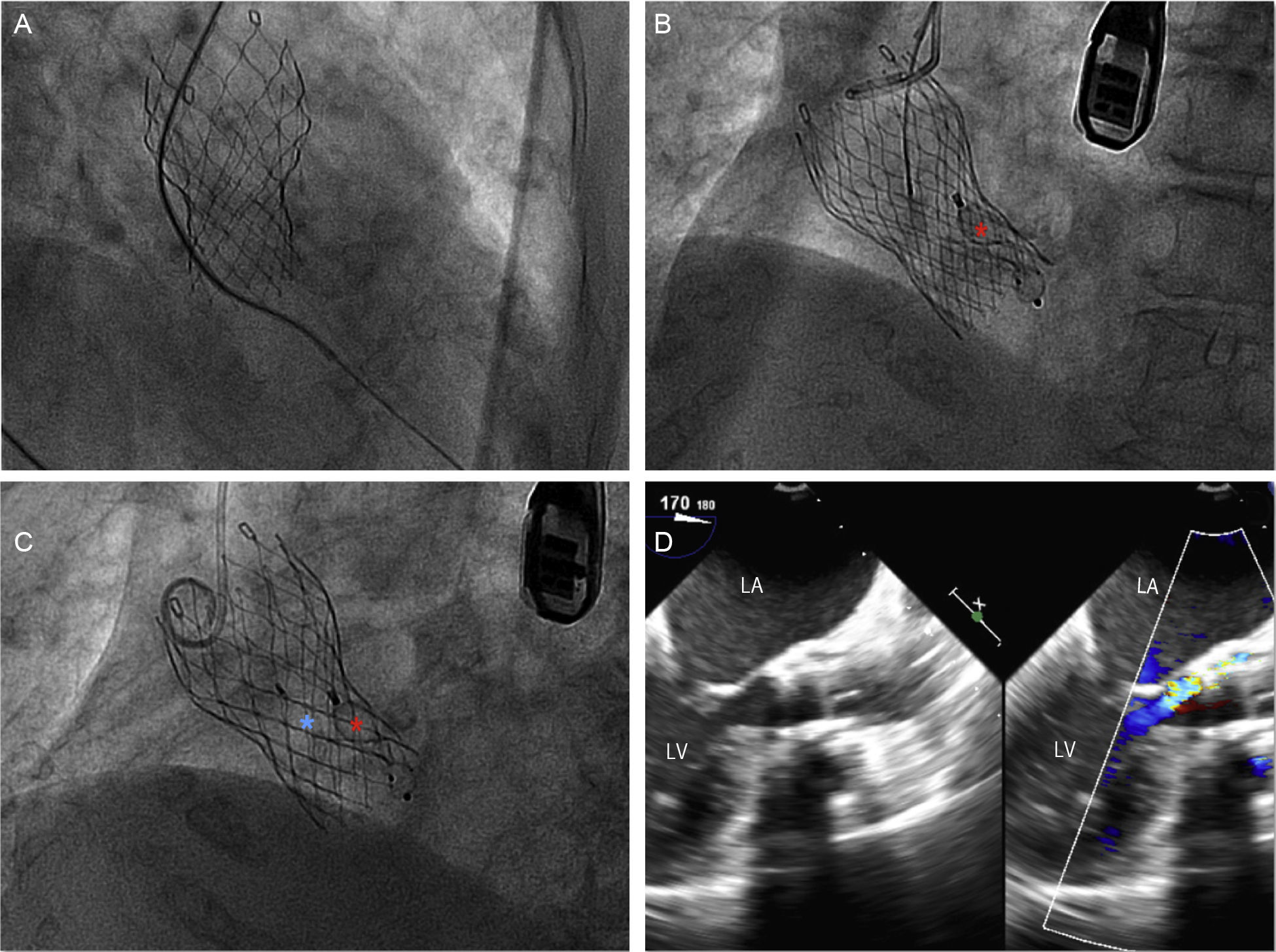 Paravalvular Leak Closure After Transcatheter Aortic Valve Implantation ...
